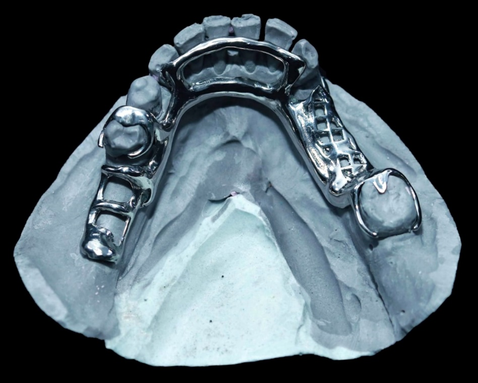 Revolutionizing Rehabilitation: Prosthodontic Management of Distal Extension Using Cobalt ...